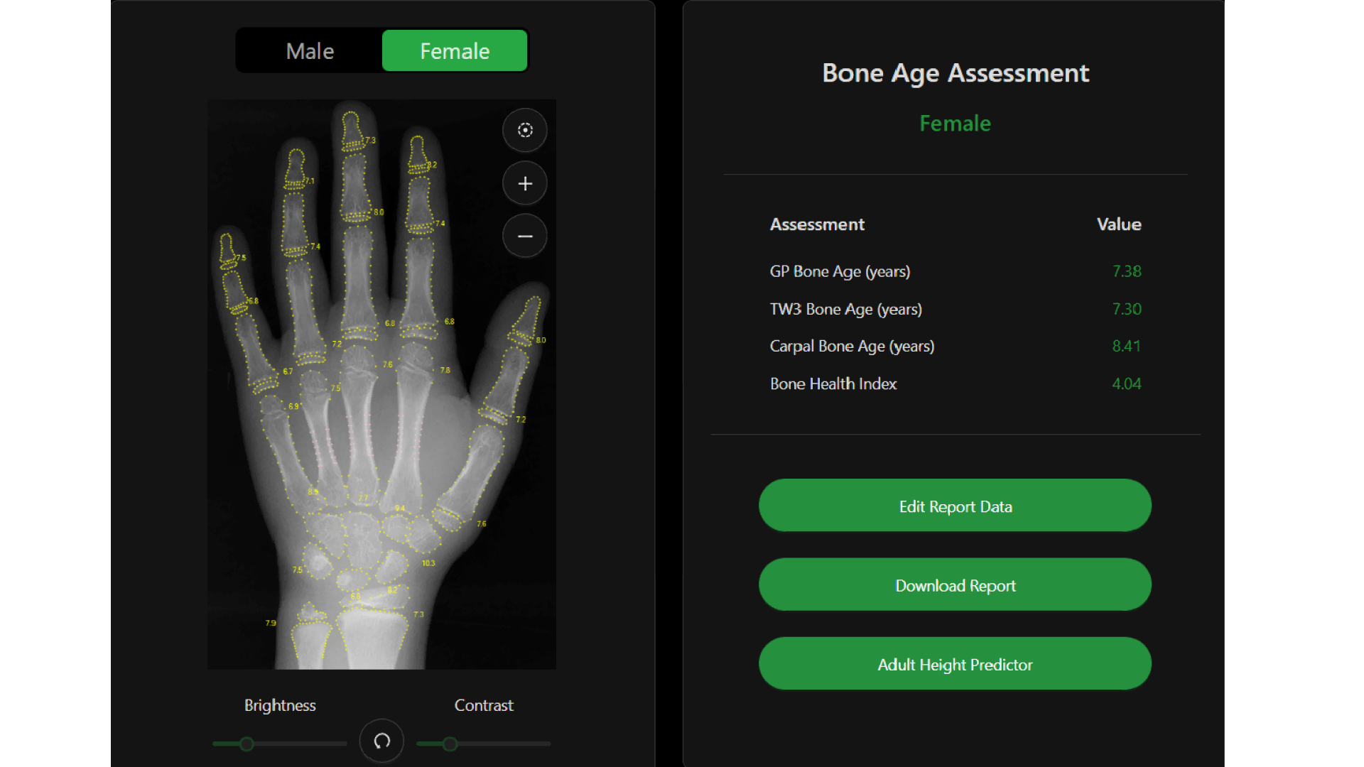 BoneXpert Online – Automated bone age analysis in your browser - BoneXpert